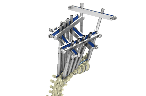 CHARSPINE2 VD direct vertebral body derotation - ChM sp. z o.o.